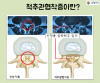 척추관협착증 비수술 치료방법과 척추관협착증에 좋은 운동요법 네이버 블로그